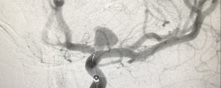 Cerus Endovascular announces implant of Contour device with Xcath robot